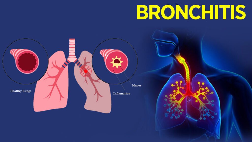 Acute Bronchitis – Symptoms, Causes, Remedies - HealthINX